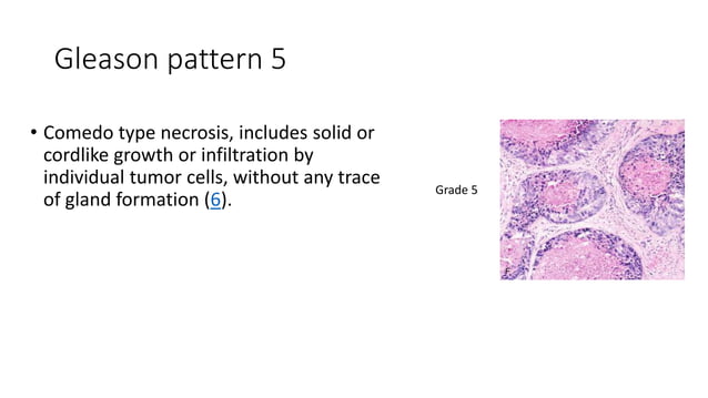 Gleason grading system | PPTX