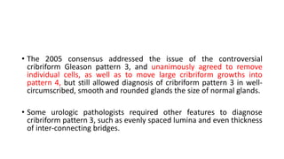 Gleason grading system | PPTX
