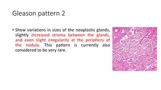 Gleason grading system | PPTX