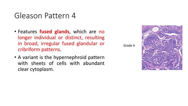 Gleason grading system | PPTX