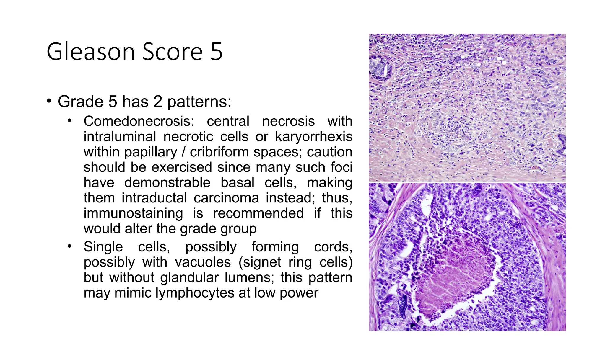 Gleason Score perhitungan untuk cancer prostat | PPTX