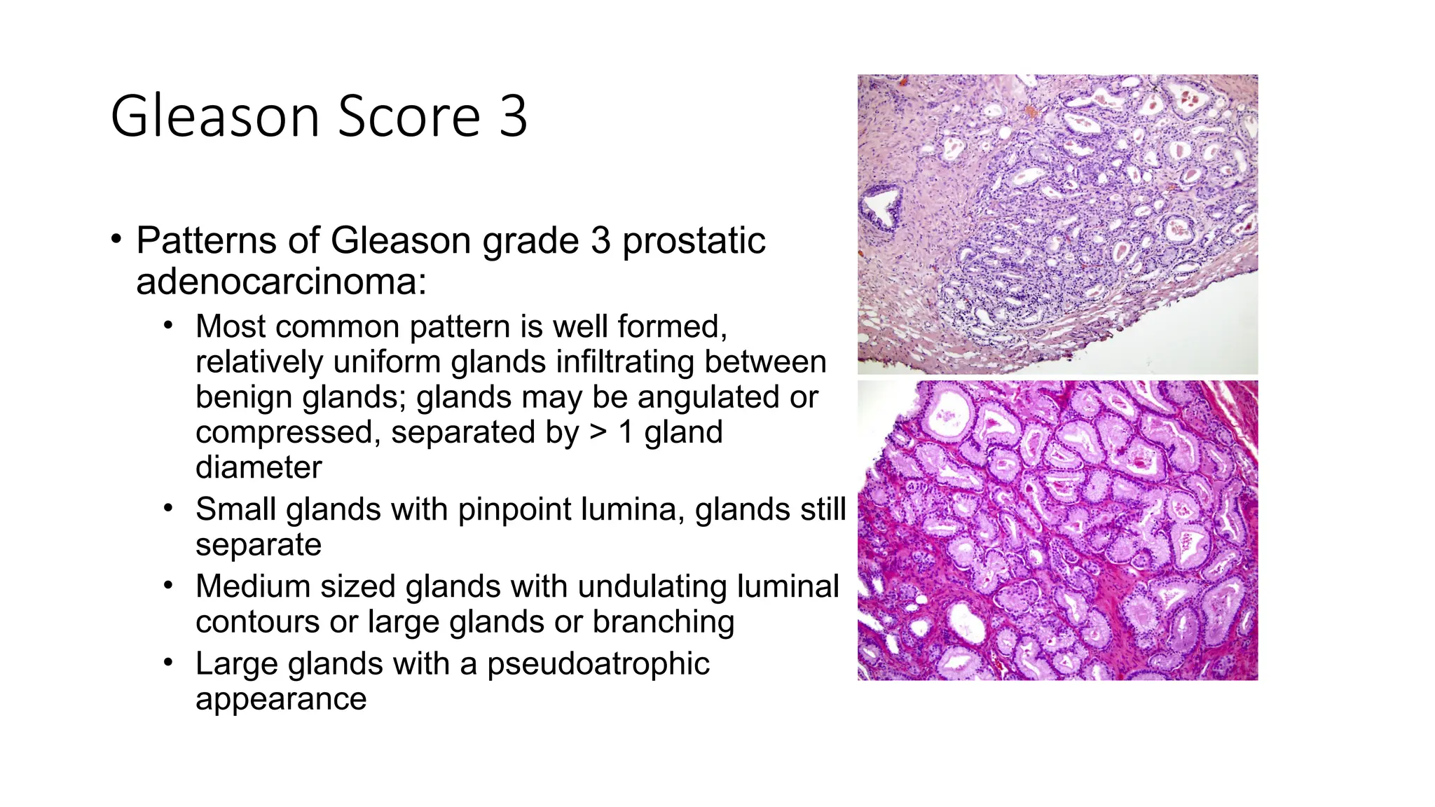 Gleason Score perhitungan untuk cancer prostat | PPTX