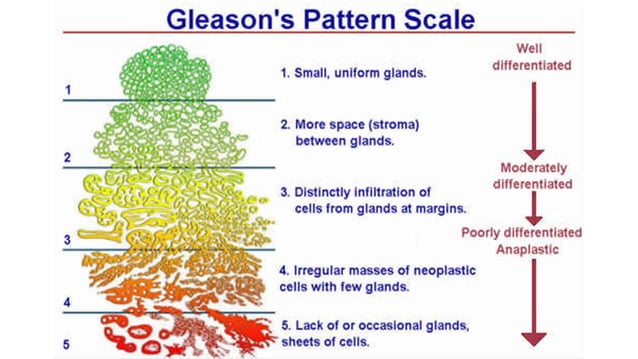Gleason Score perhitungan untuk cancer prostat | PPTX
