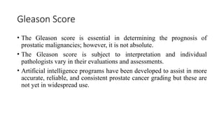 Gleason Score perhitungan untuk cancer prostat | PPTX