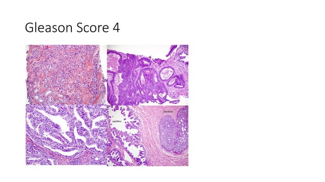 Gleason Score perhitungan untuk cancer prostat | PPTX