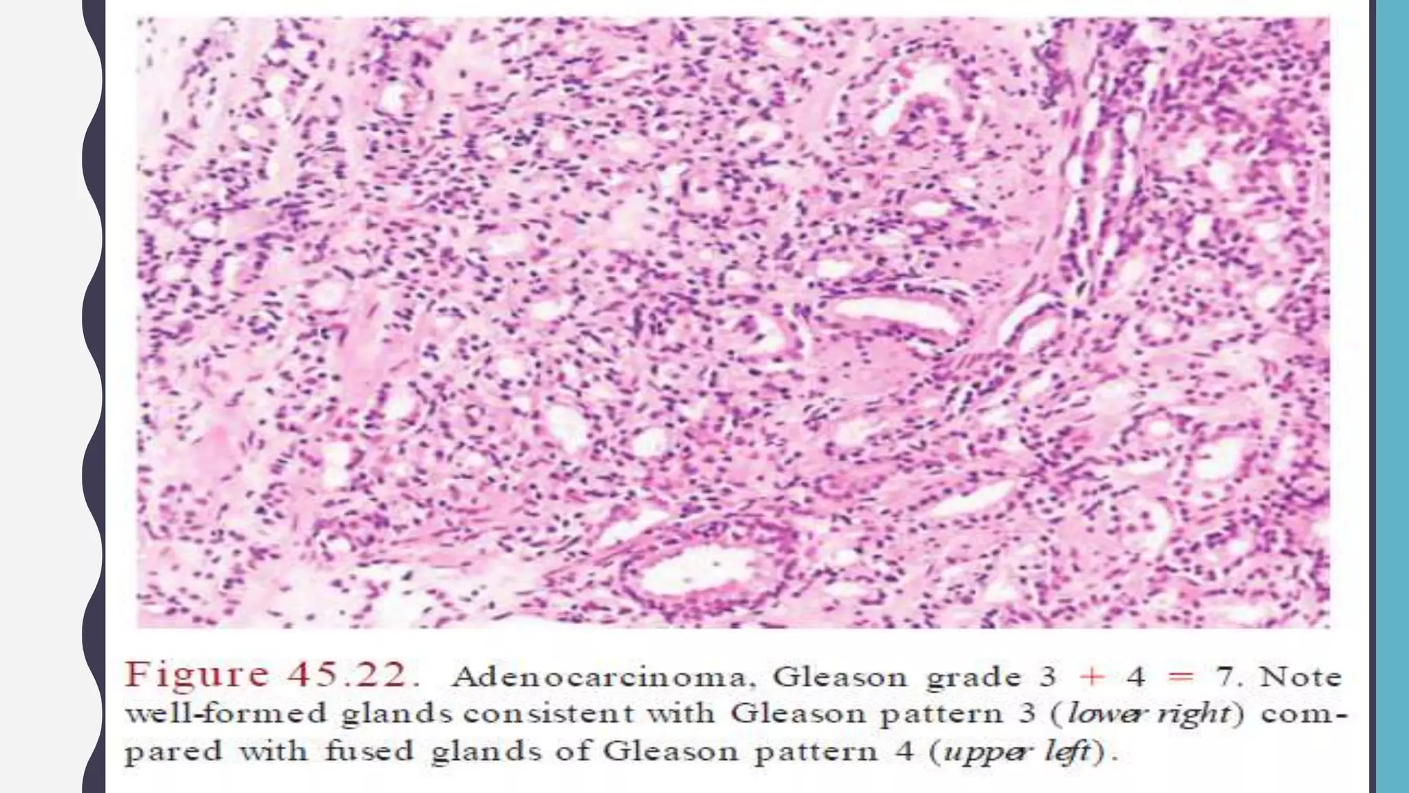 Gleasons scoring system | PPTX