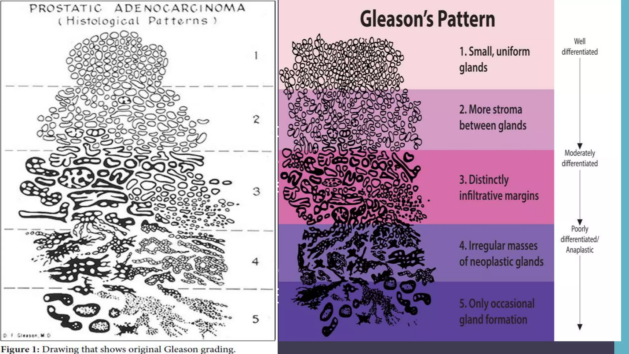 Gleasons scoring system | PPTX