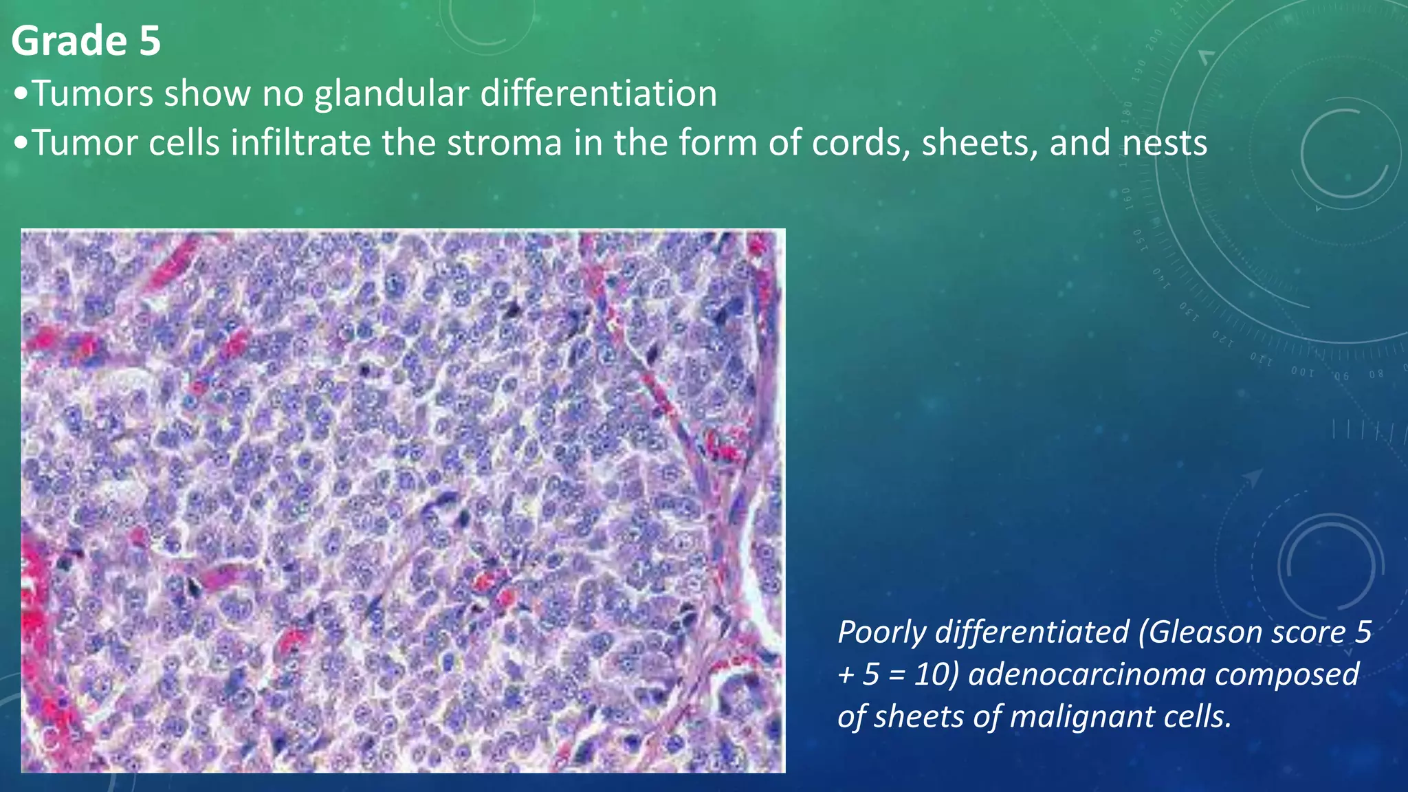 Gleason system of grading prostate cancer | PPTX