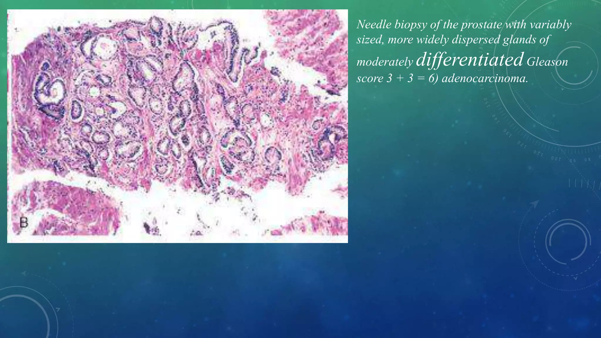 Gleason system of grading prostate cancer | PPTX