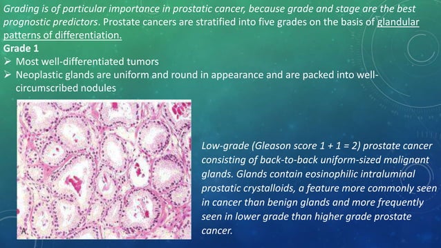 Gleason system of grading prostate cancer | PPTX | Cancer | Diseases ...