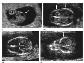 Anensefali Ultrasonu