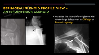 Glenohumeral instability Radiological evaluation - Dr Srivatsa Gumma | PDF