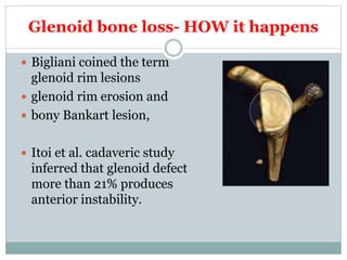 Assessment Of Glenoid Bone Loss In Recurrent Shoulder Dislocation | PPTX