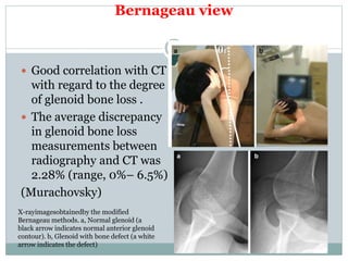 Assessment Of Glenoid Bone Loss In Recurrent Shoulder Dislocation | PPTX