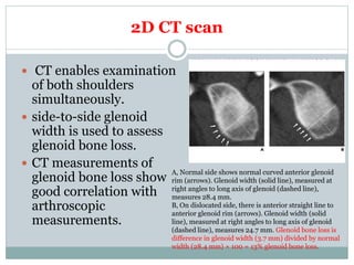 Assessment Of Glenoid Bone Loss In Recurrent Shoulder Dislocation | PPTX