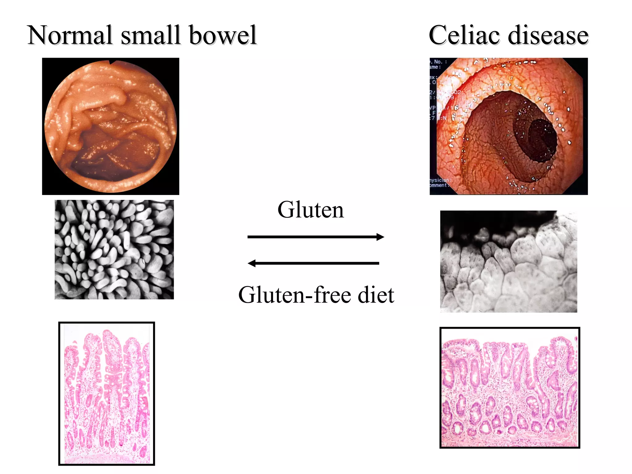 Gliadin, Intestinal Permeability, and Celiac Disease: From Innate ...
