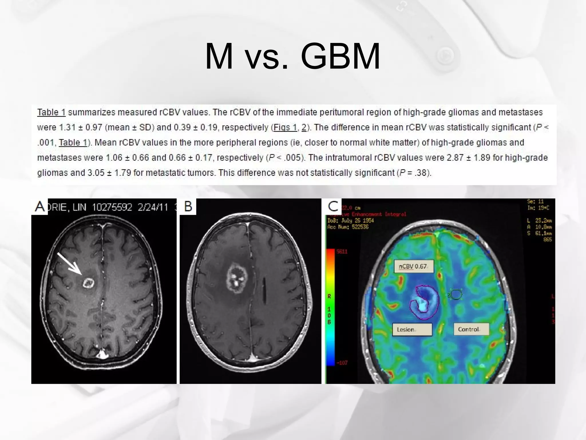 Chẩn đoán hình ảnh Glioblastoma (GBM) | PPT