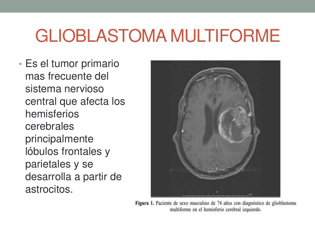 Glioblastoma multiforme