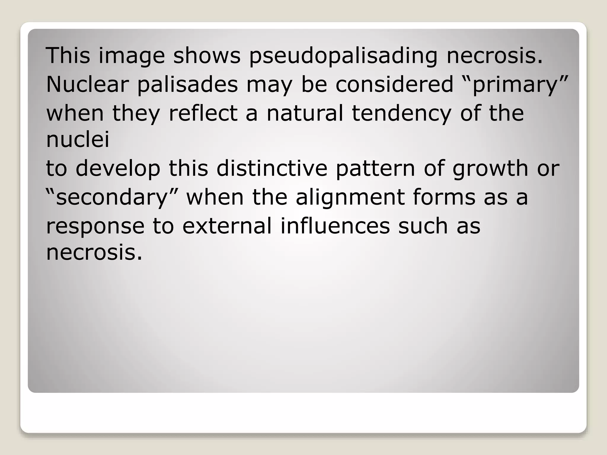 Glioblastoma multiforme | PPTX