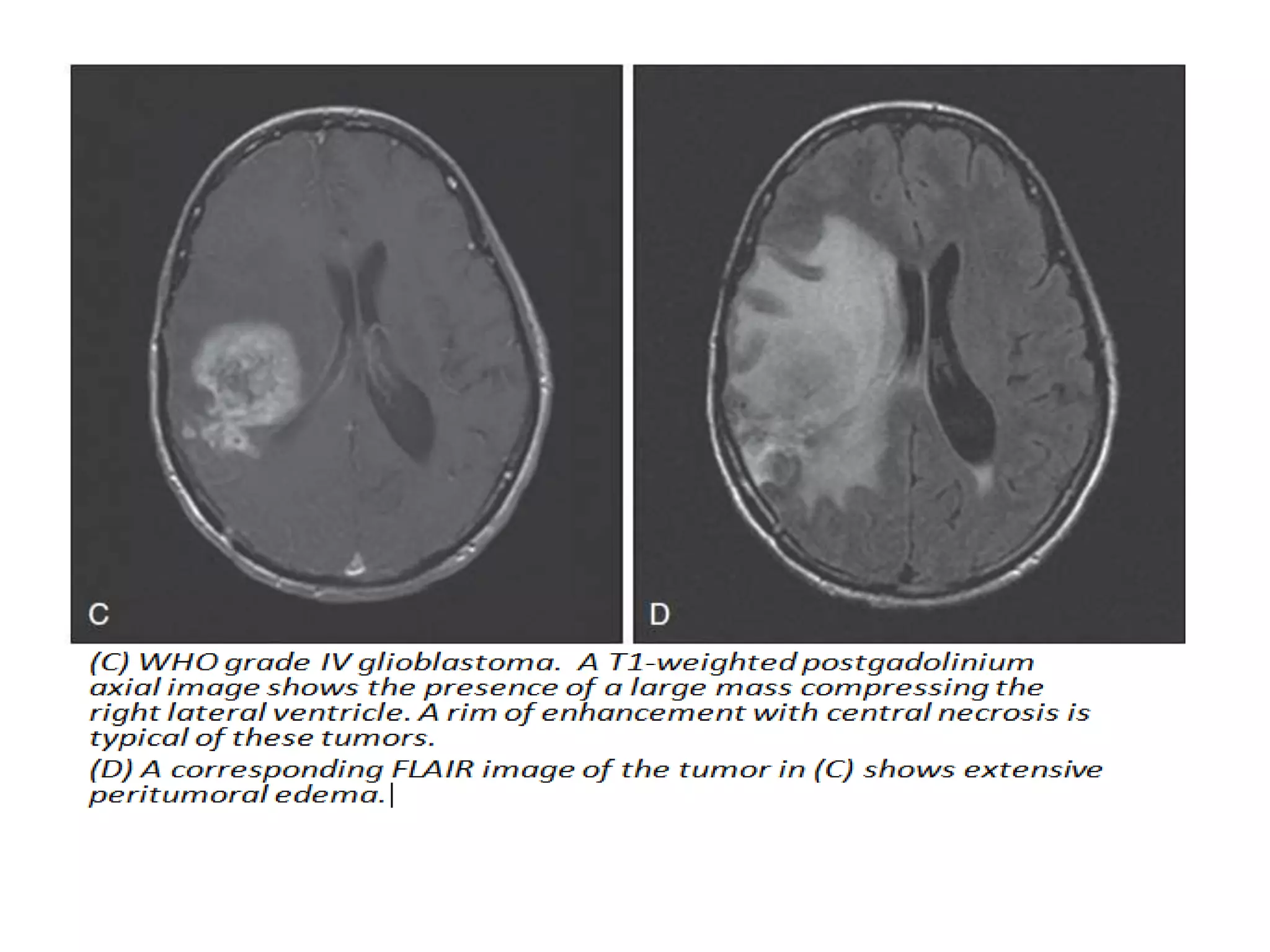 Glioblastoma multiforme (GBM) Radiotherapy planning and management ...