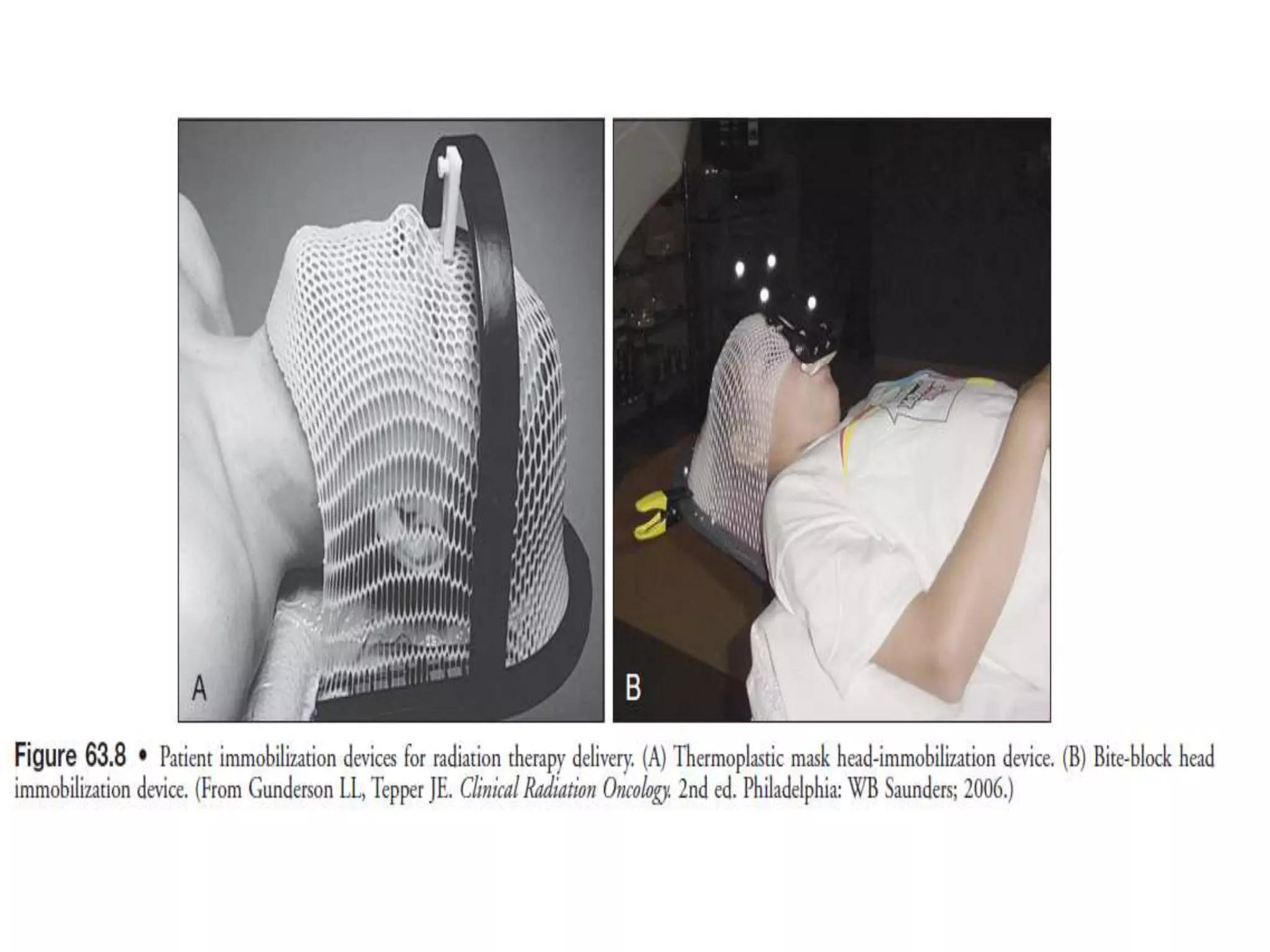 Glioblastoma multiforme (GBM) Radiotherapy planning and management ...