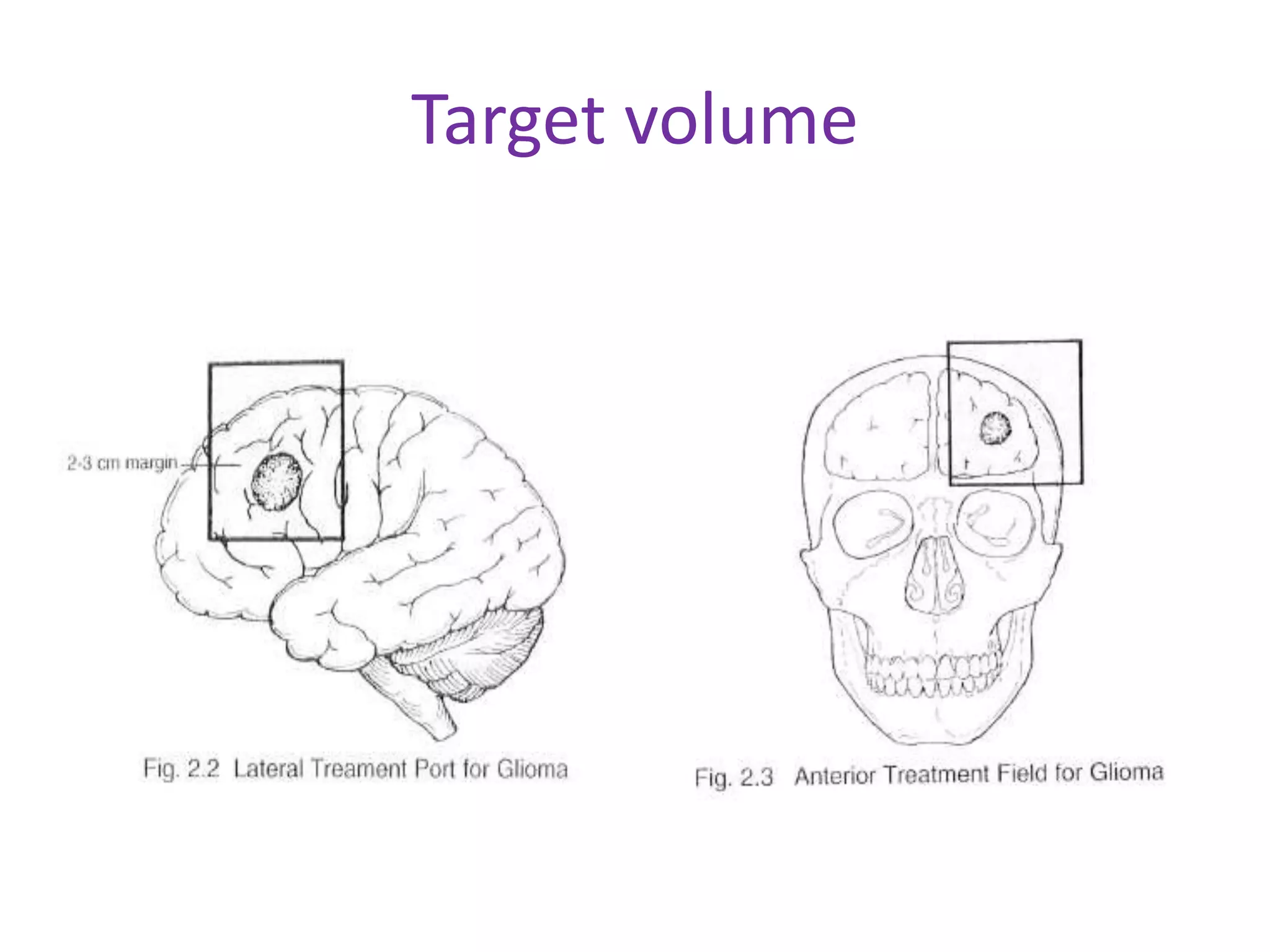 Glioblastoma multiforme (GBM) Radiotherapy planning and management ...