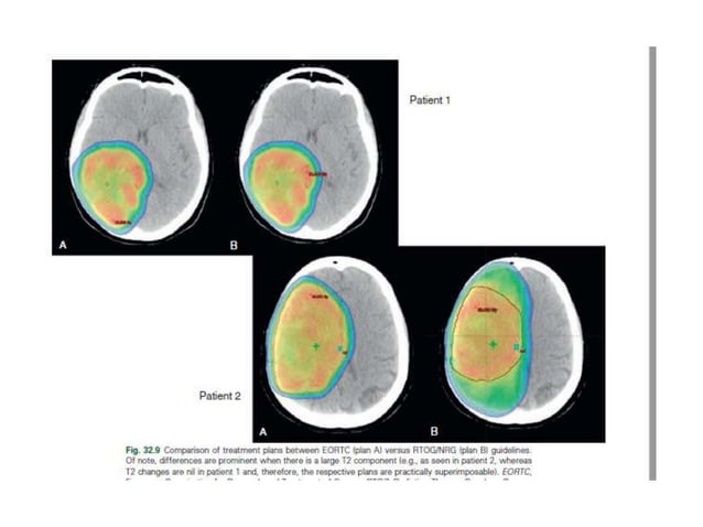 Glioblastoma multiforme (GBM) Radiotherapy planning and management ...