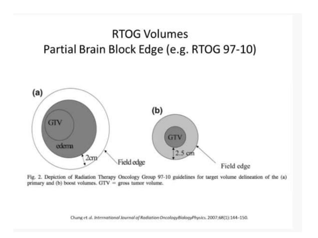 Glioblastoma multiforme (GBM) Radiotherapy planning and management ...