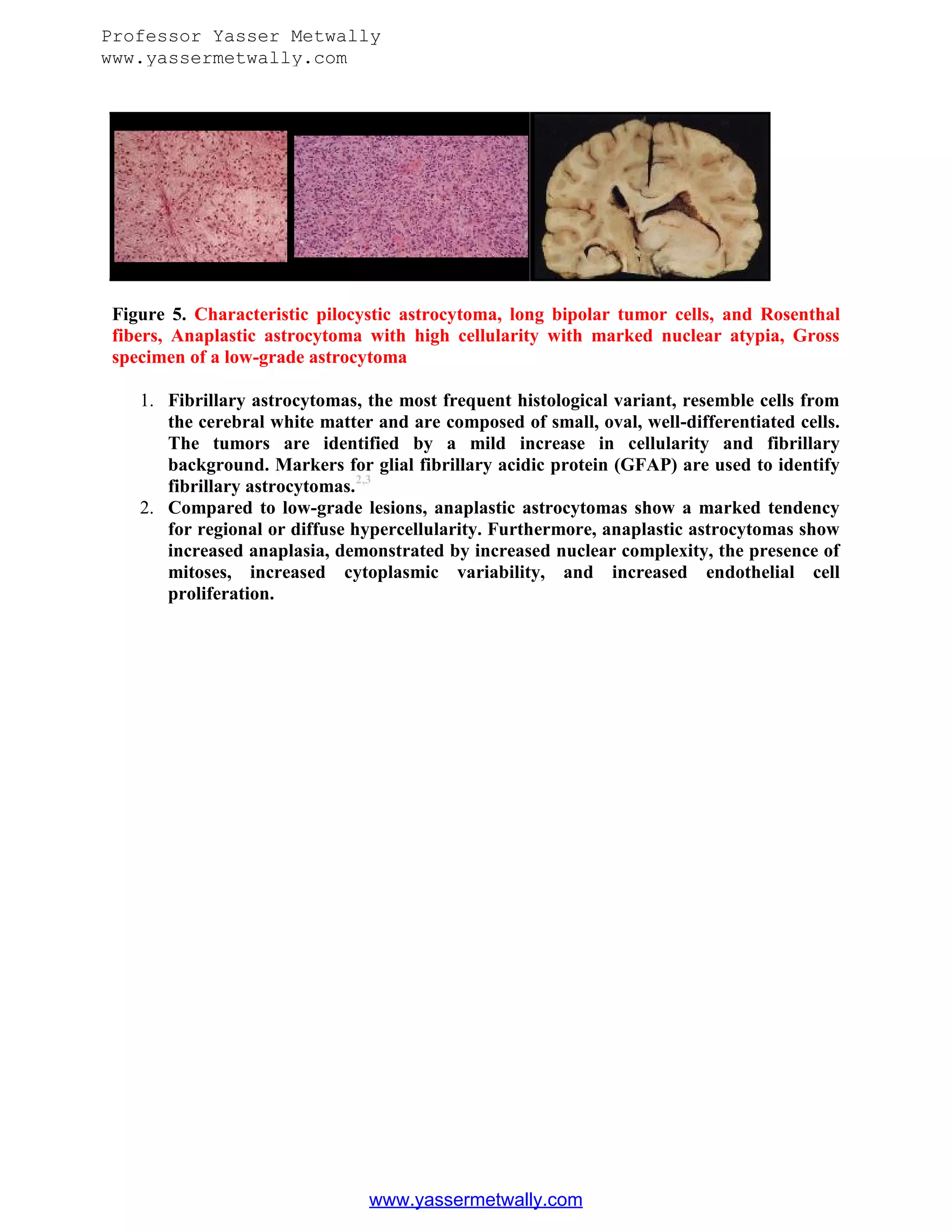 Radiological pathology of diffuse astrocytomas | PDF
