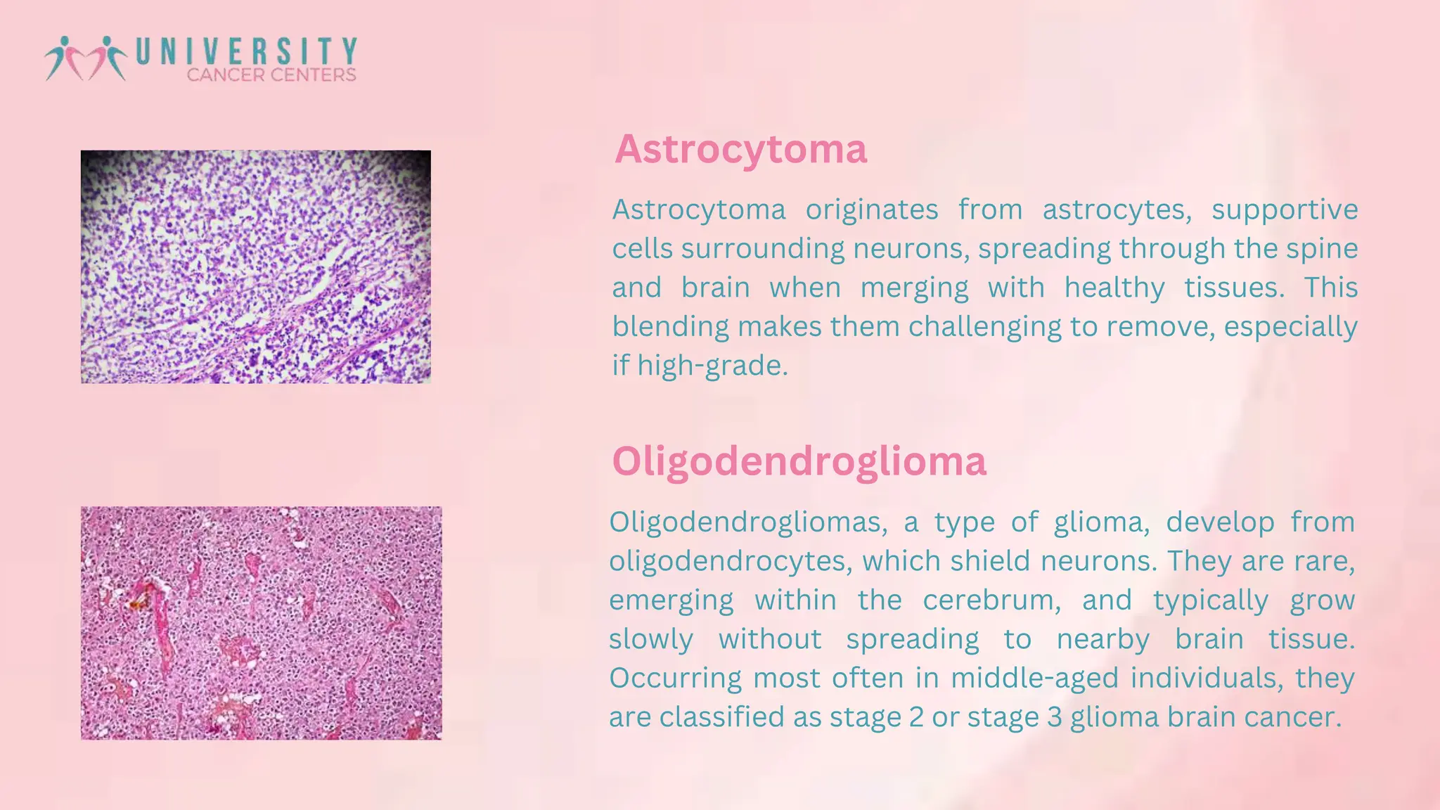 Glioma Brain Cancer Types Symptoms And Causes Ppt