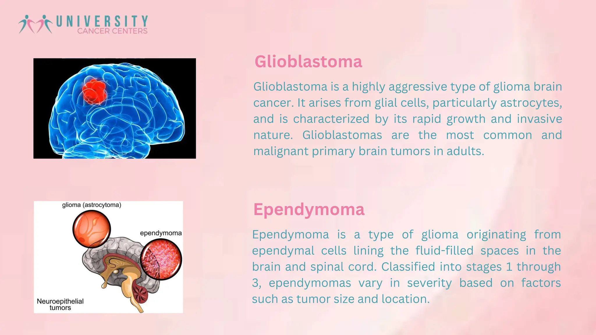 Glioma Brain Cancer-Types, Symptoms & Causes | PPT