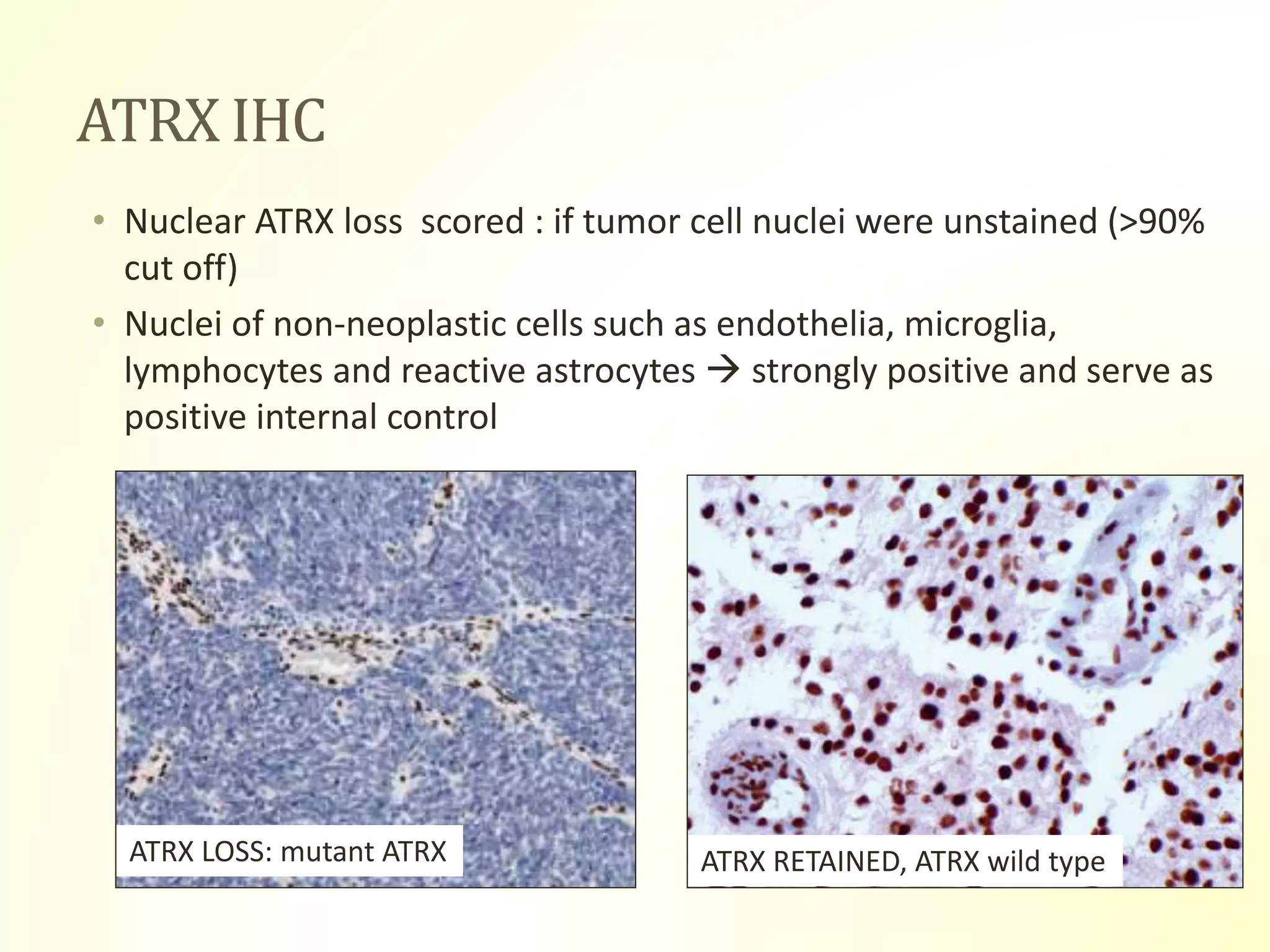 Glioma molecular markers | PPTX