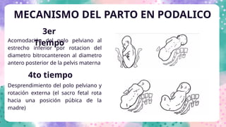 PARTO PODALICO mecanismo de parto podalico | PPTX