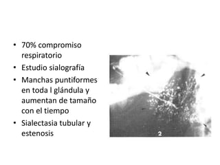 lesiones no neoplasicas de glandulas salivales | PPTX | Ear, Nose and ...