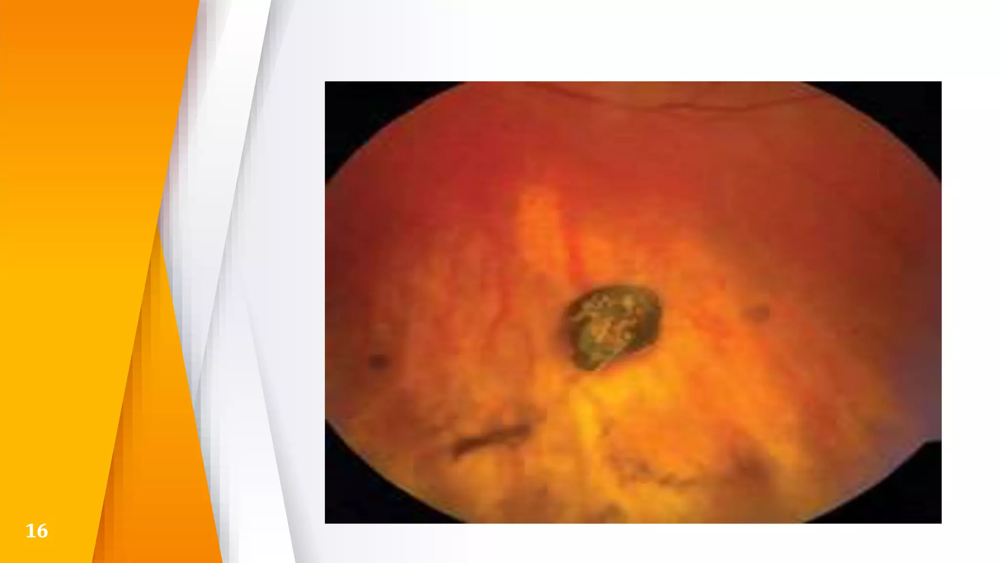 Chemical Injury & Foreign Body Ocular Injury | PPTX