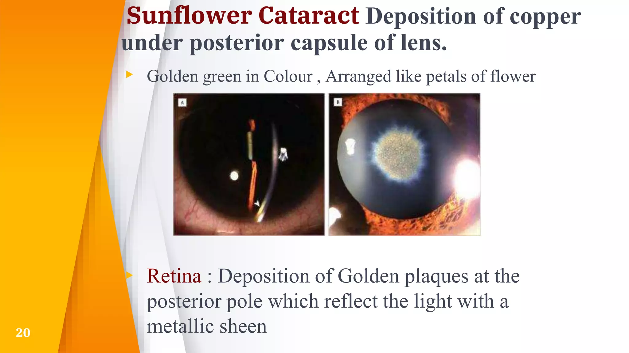 Chemical Injury & Foreign Body Ocular Injury | PPTX