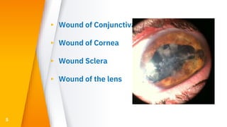 Chemical Injury & Foreign Body Ocular Injury | PPTX