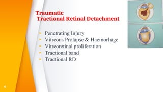 Chemical Injury & Foreign Body Ocular Injury | PPTX