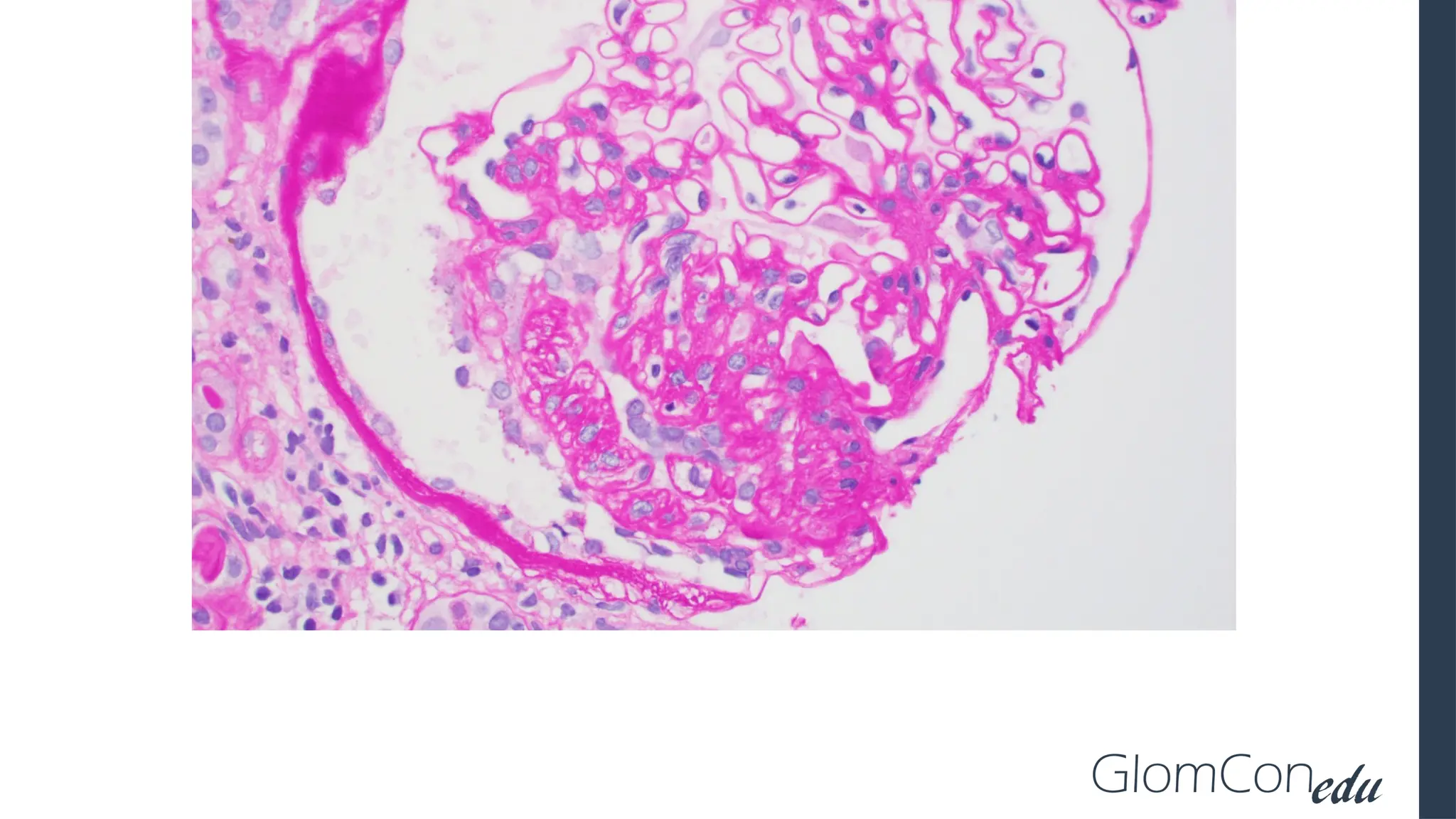 Glom Con: Basics of Focal Segmental Glomerulosclerosis (FSGS) | POTX