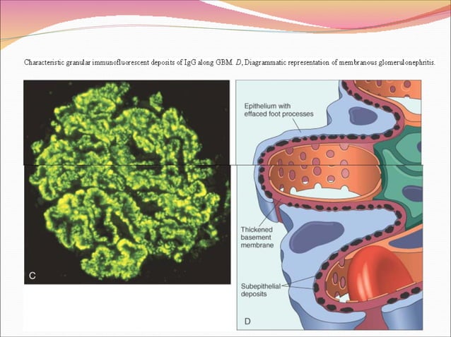 CME: Glomerular & Tubular Disorders | PPT | Blood Disorders | Diseases ...