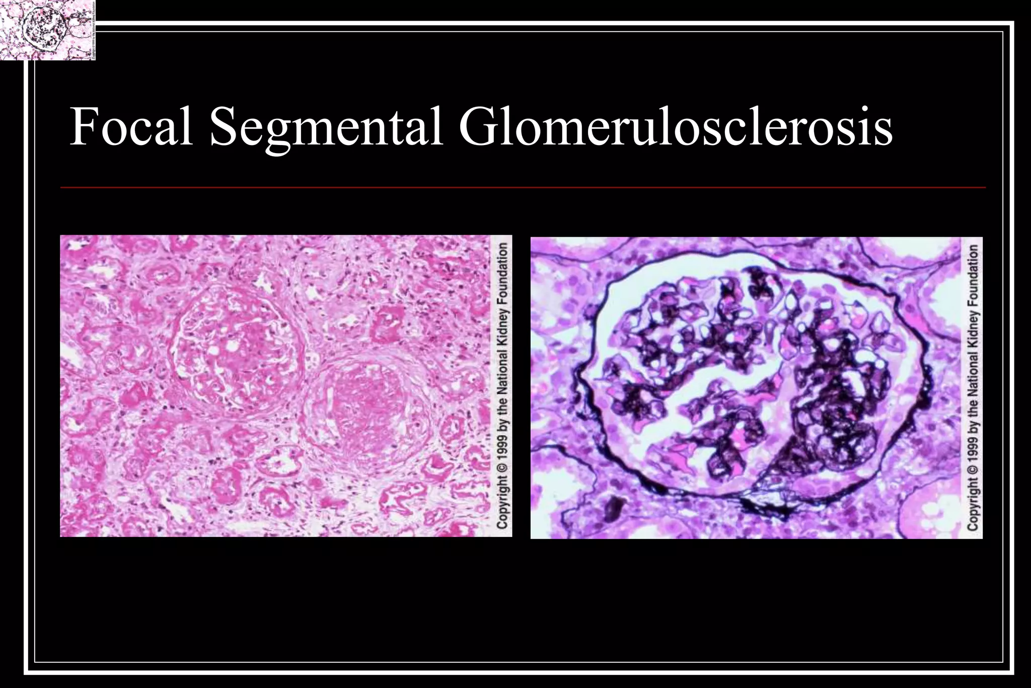 Glomerular-Diseases2.ppt