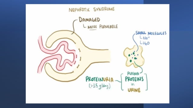 Nephrotic & Nephritic Syndromes. Dr. Abhinav Golla , Associate ...