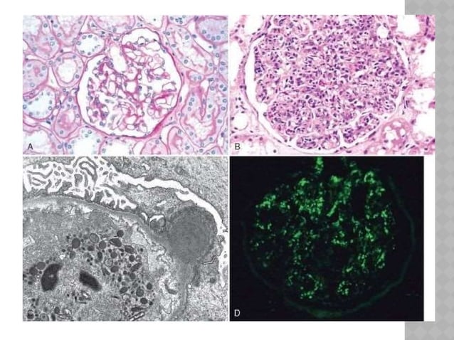 Glomerular Diseases with Histopathology . Dr. Abhinav Golla , Associate ...