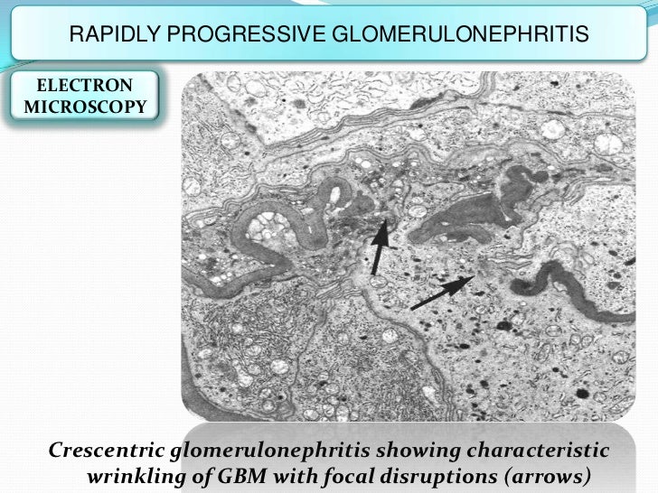 Glomerular diseases