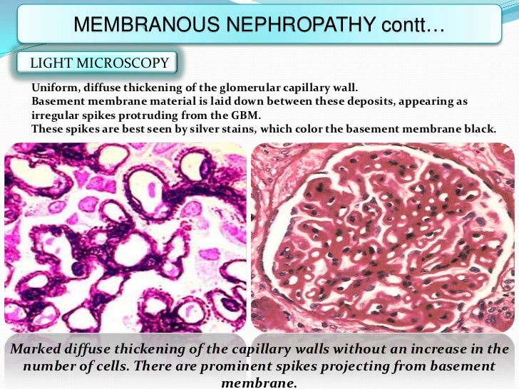Glomerular diseases