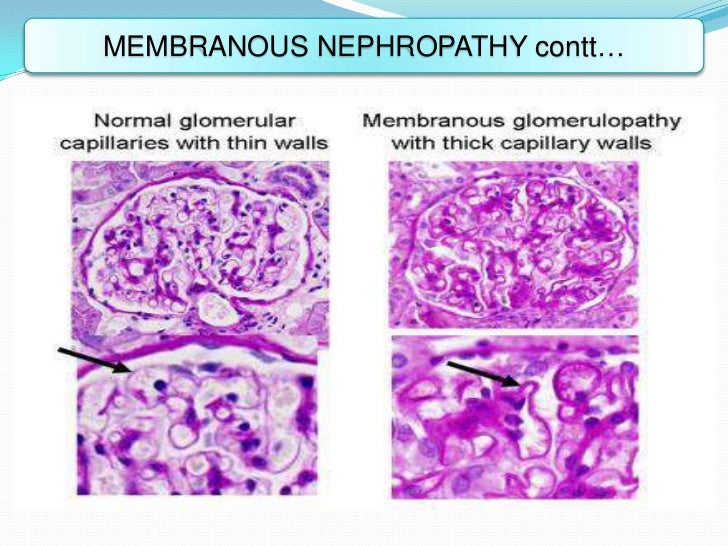 Glomerular diseases