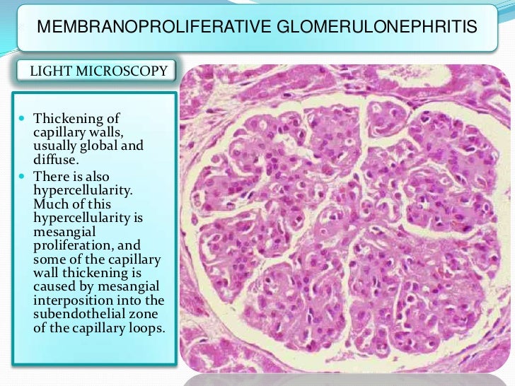 Glomerular diseases