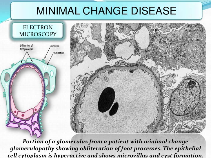 Glomerular diseases