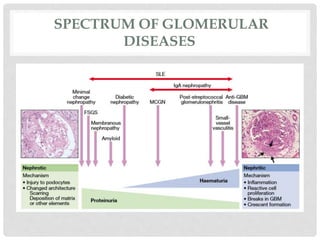 Glomerular diseases | PPTX