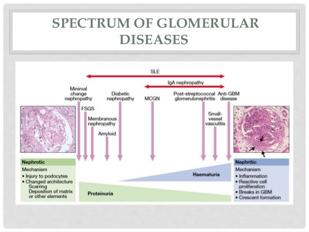 Glomerular Disease